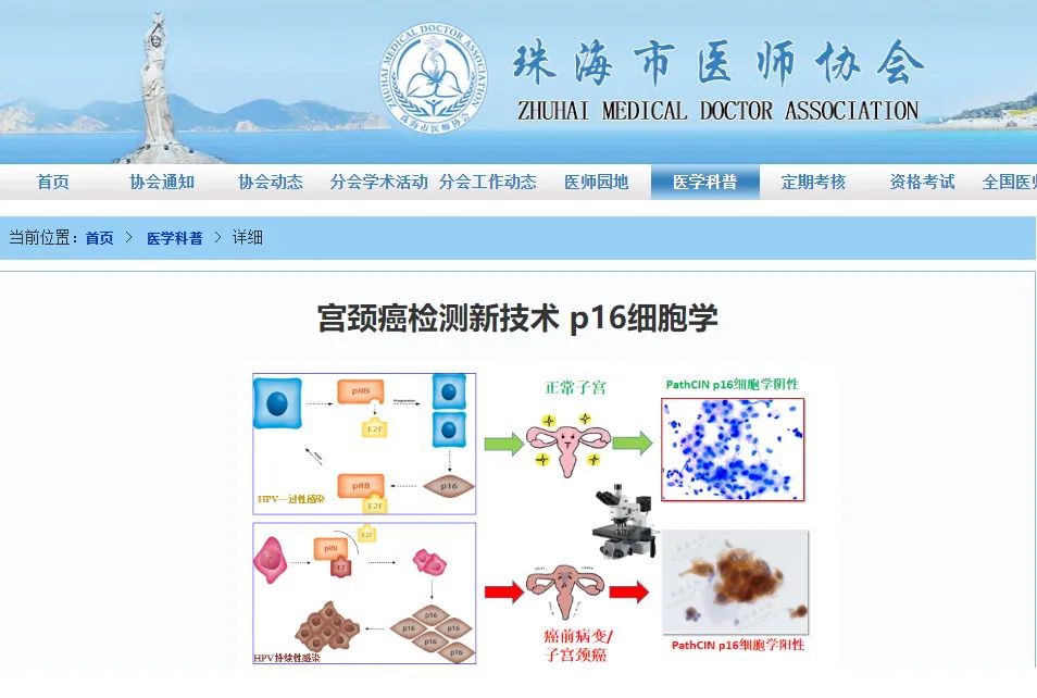 今日聚焦：森盈宫颈癌检测新技术p16细胞学荣获珠海市医师协会的认可，并在其官网发布医学科普。 - 深圳市森盈生物科技有限公司