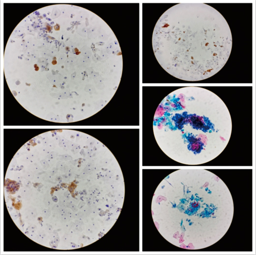 森盈生物p16染色临床案例：43岁，p16上色的细胞很多 - 深圳市森盈生物科技有限公司